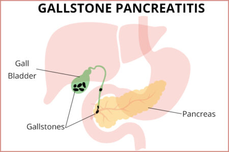 Gallstone Pancreatitis: Causes, Symptoms, & Treatment
