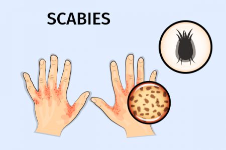 Scabies: Causes, Symptoms, Treatment, & Complications