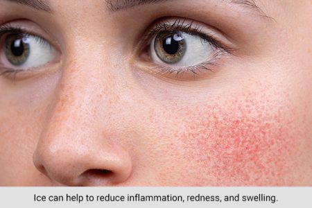 Redness on Face After Applying Ice: Causes & Tips to Prevent It
